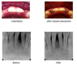 Ridge Augmentation – Bone Grafting in Orange County