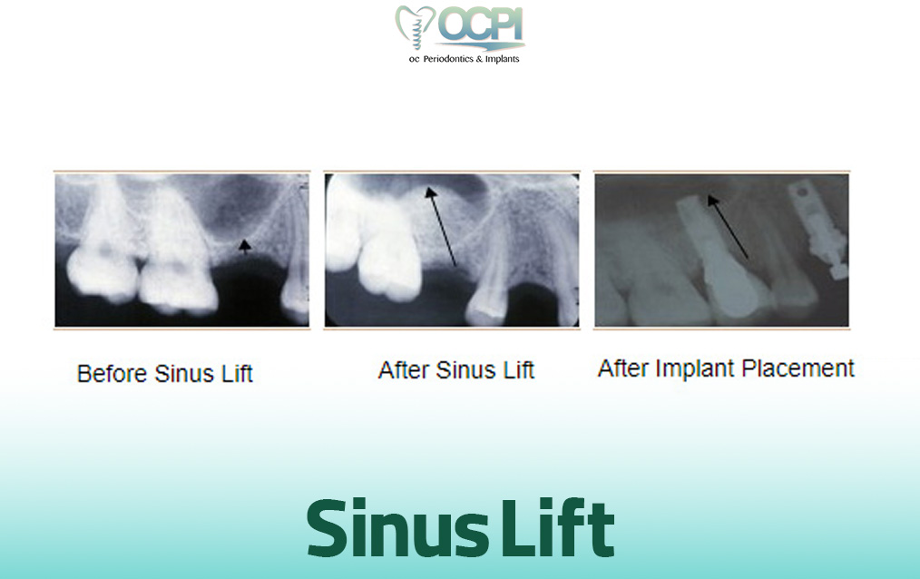 Best Sinus Lift Surgery in Orange County