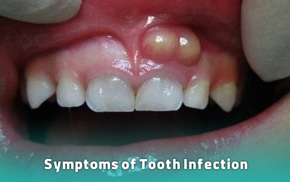 Symptoms Of Tooth Infection Symptoms Of Tooth Infection