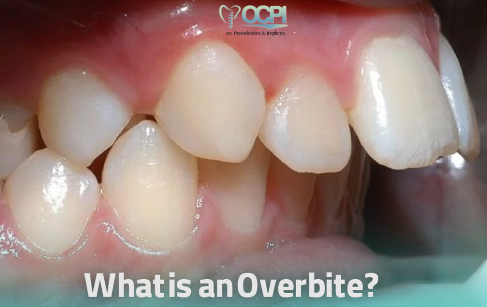 What is a Overbite ? - Nooshin Ghayoumi DDS