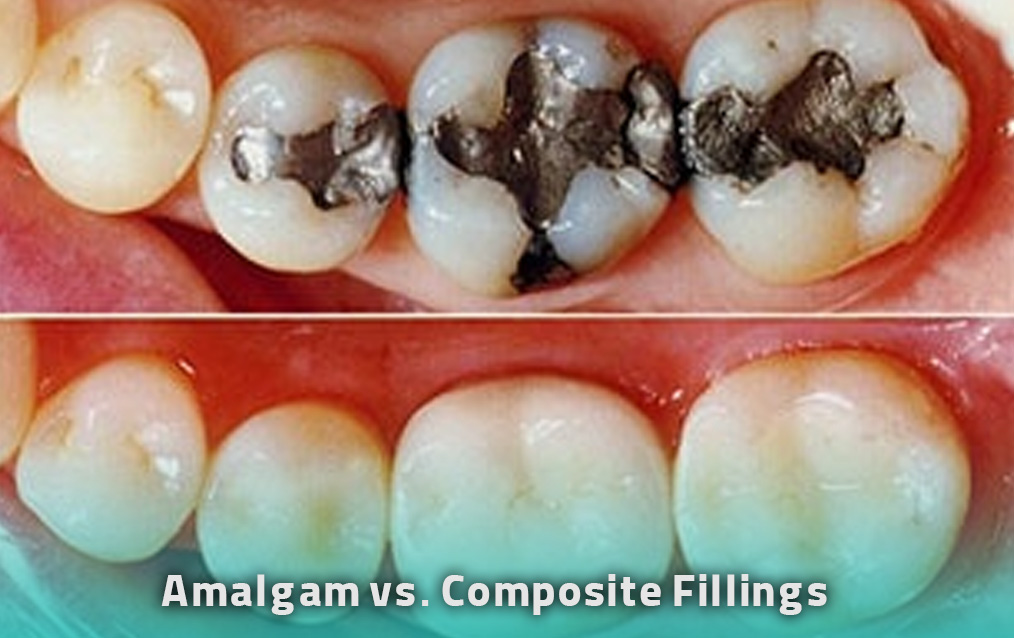 Amalgam Vs Composite Fillings Which Is Better 