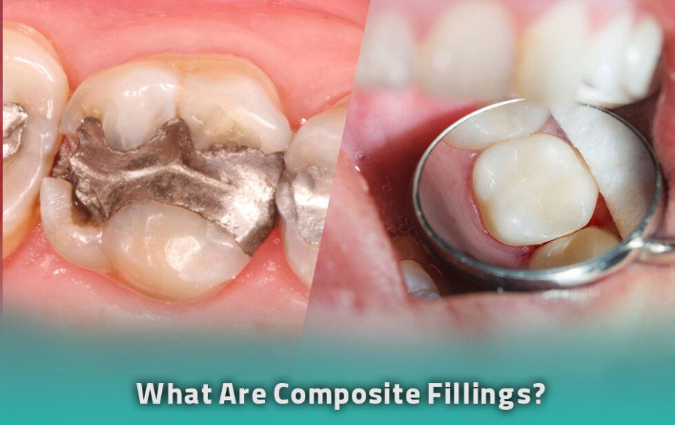 Amalgam vs. Composite Fillings: Which is Better?
