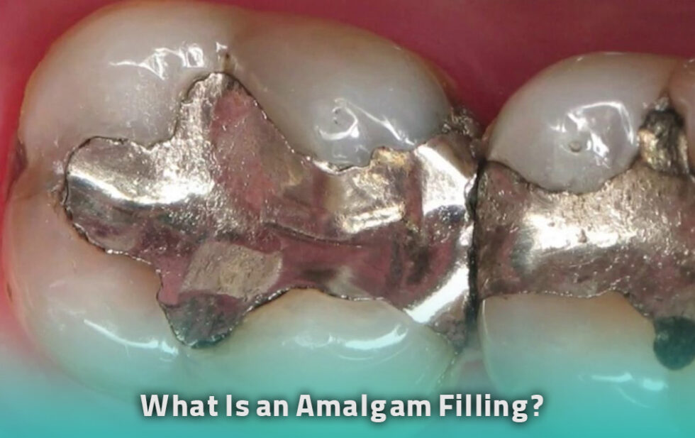 Amalgam vs. Composite Fillings: Which is Better?