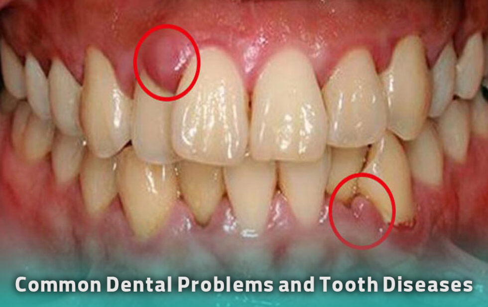 10 Common Dental Problems and Tooth Diseases