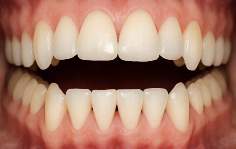 What Is an Open Bite and How Is It Treated?