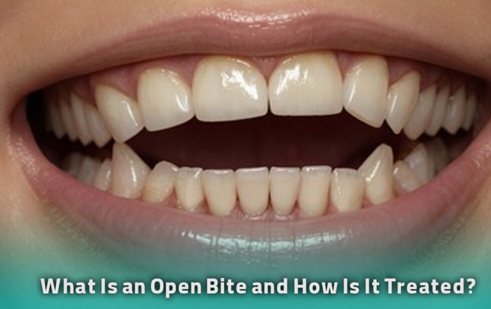 What Is an Open Bite and How Is It Treated?